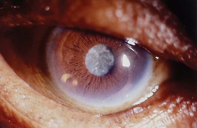 10 Interesting Facts about Blindness - Fact City