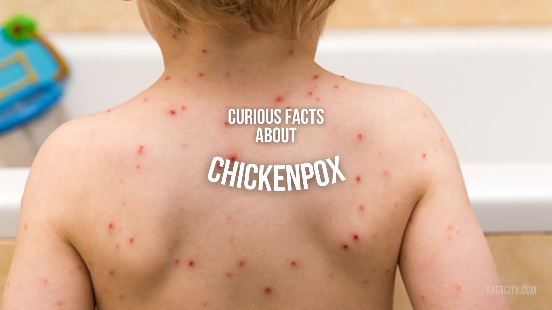 12 Curious Facts About Chickenpox - Fact City
